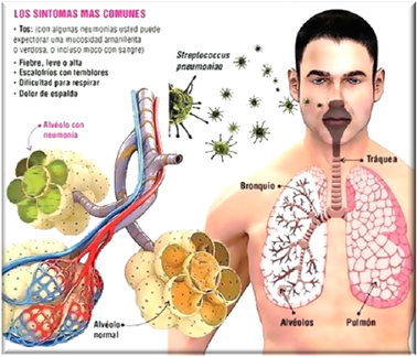 Patologia B- 2013: Infecciones pulmonares