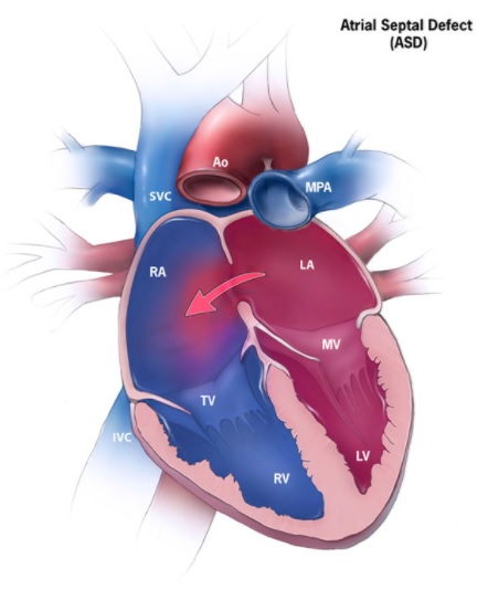 Defek Septum Atrium: Patofisiologi, Diagnosis, Tatalaksana, dan ...