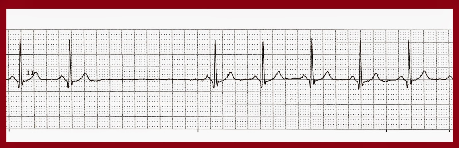 Practice EKG Strips 386