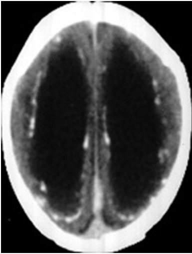 Cytomegalovirus CMV Infection in Newborn. Transmission of CMV Infection ...