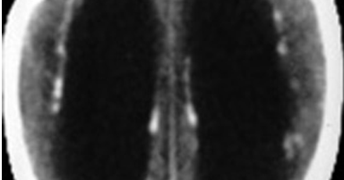 Cytomegalovirus CMV Infection in Newborn. Transmission of CMV Infection ...