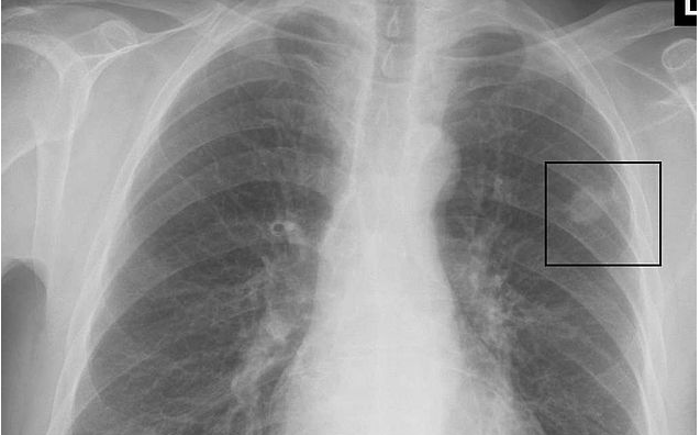 Coisa Acadêmica: Câncer de Pulmão e a Radioterapia