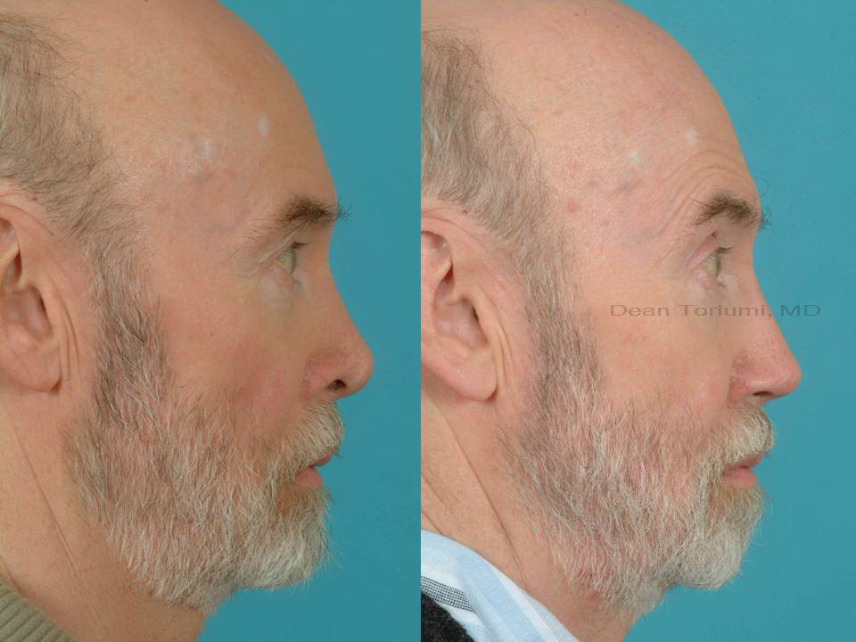 Dr. Dean Toriumi Reviews: Dean Toriumi Reviews: Secondary rhinoplasty ...
