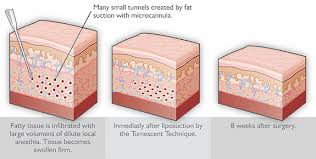 The Well-Rounded Mama: Lipedema Treatment, Part 5c: Tumescent Liposuction