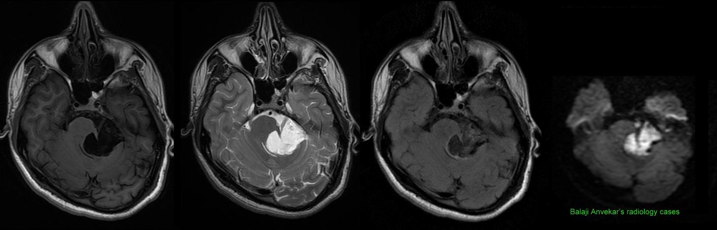 Epidermoid Cyst Brain