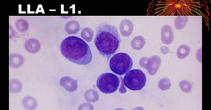 Fichero de Hematologia: Leucemia Linfoide Aguda