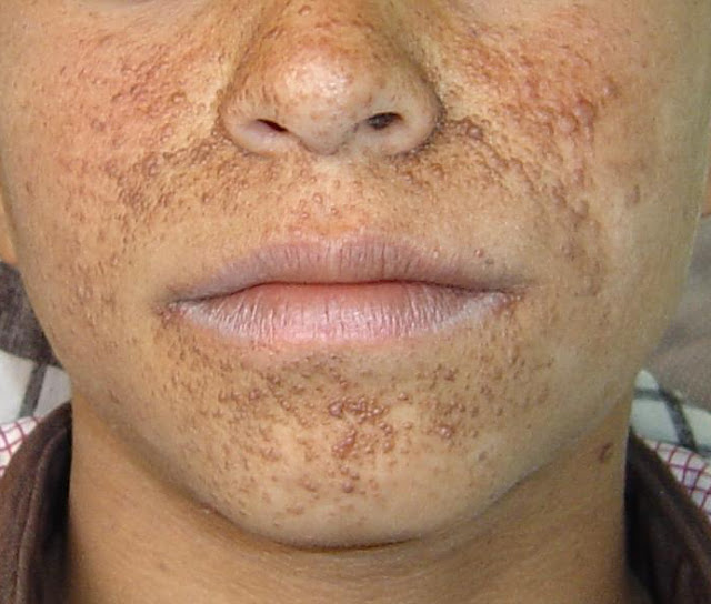 Facial Angiofibromas Associated with Tuberous Sclerosis