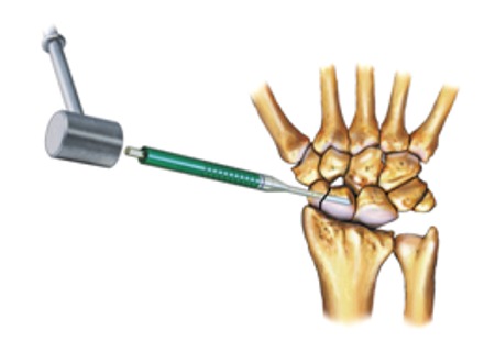 Straining Forward: Anatomy and Physiology: Treatments for Broken Bones