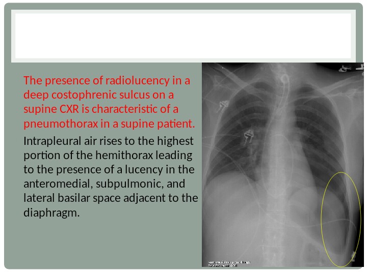 Chest Medicine Made Easy-Dr Deepu: Important chest radiology signs.