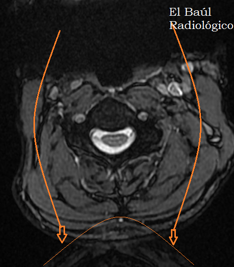 El Baúl Radiológico: ARTEFACTOS POR SUPERPOSICIÓN EN EL SENTIDO DE LA ...
