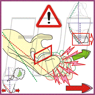 Fisiohipótesis: 9-1-Disfunción hombro en protracción.