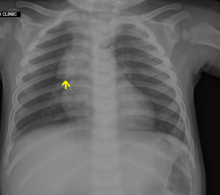Thymic Sail Sign-Plain Film - Sumer's Radiology Blog