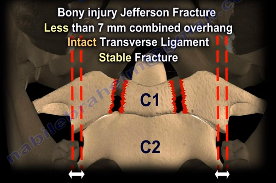 Dr. Nabil Ebraheim's Blogspot: Jefferson Fractures