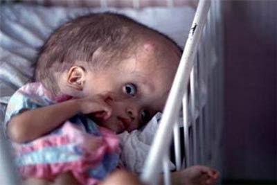 SBC: Vietnam - Abnormal babies and the pain from Tu Du Obstetrics Hospital