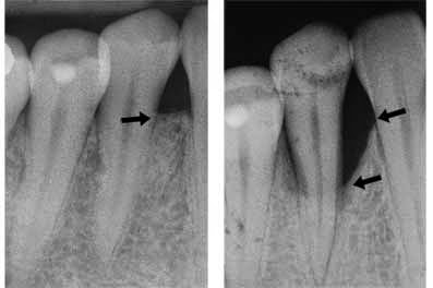 Gigipedia: Karang Gigi