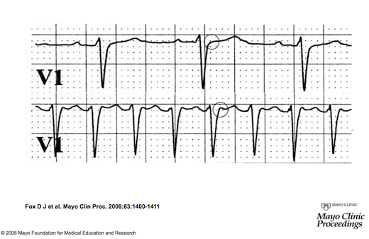 Atrioventricular Nodal Reentry Tachycardia | INA - ECG