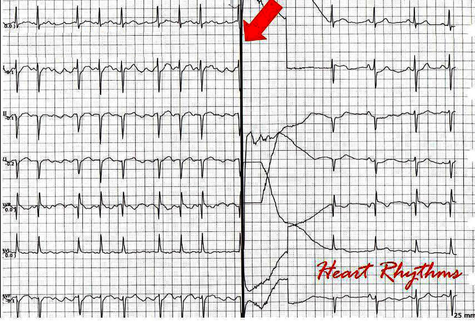 ECG Rhythms: AF cardioversion