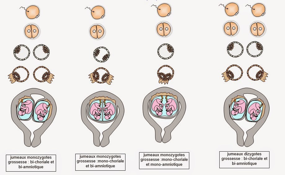 PARENTS DE JUMEAUX, notre vie croustillante: 4 Nuances de grossesses ...