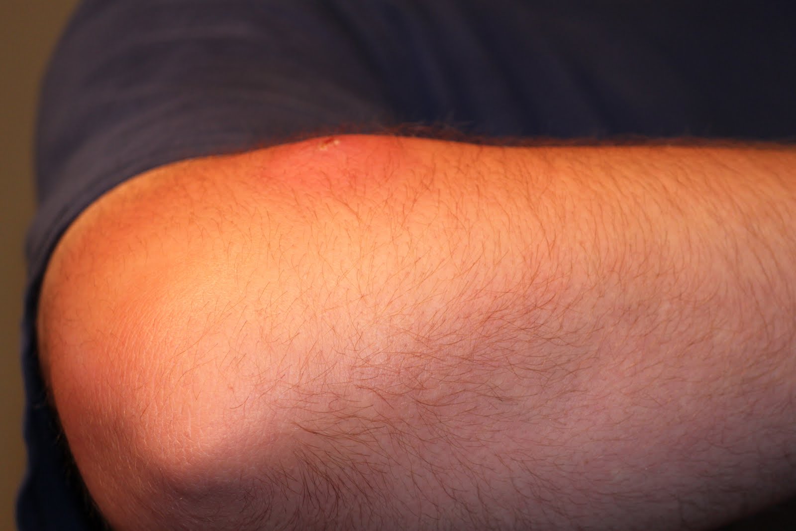 Keeping Up With The Joneses...: Spider Bite Progress