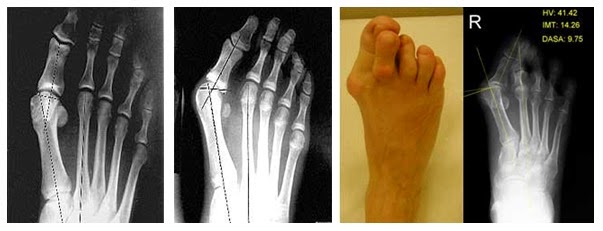 Deformiteti stopala: Čukljevi - Hallux valgus.