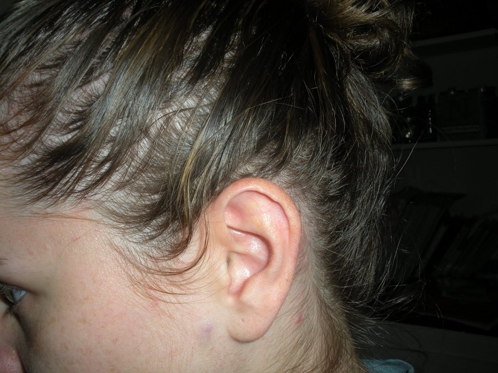 PCOS, TTC, and Me: Symptoms