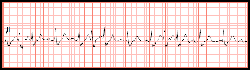Practice EKG Strips
