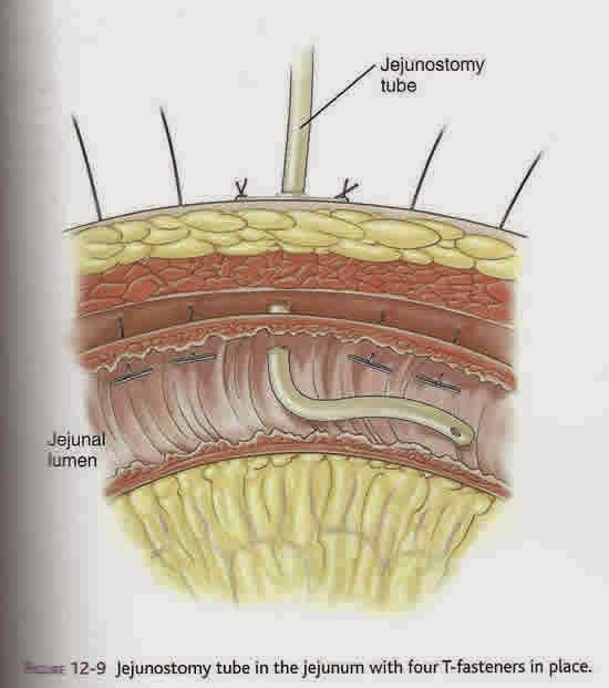 Medical Treatment Pictures-for Better Understanding: Laparoscopic ...
