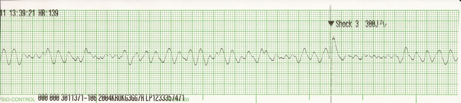ACLS review: Pulseless VF/VT Part 5