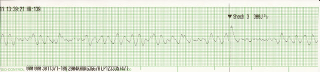 ACLS review: Pulseless VF/VT Part 5