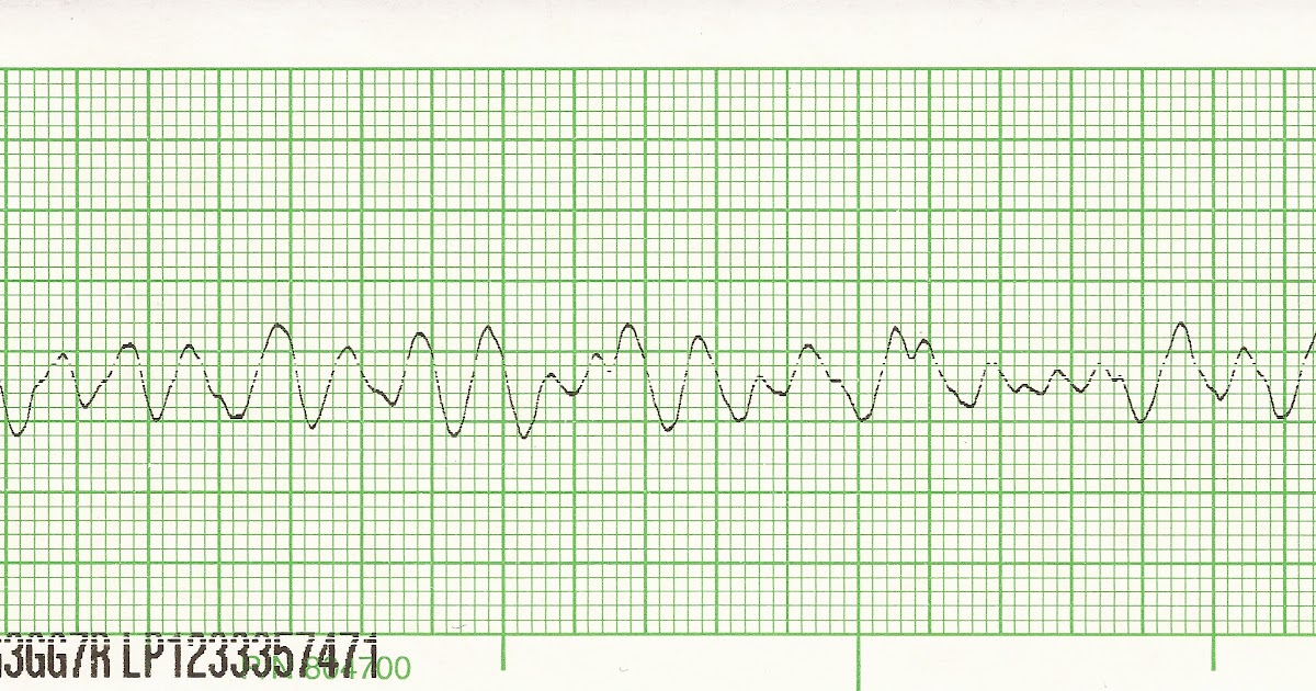 ACLS review: Pulseless VF/VT Part 5
