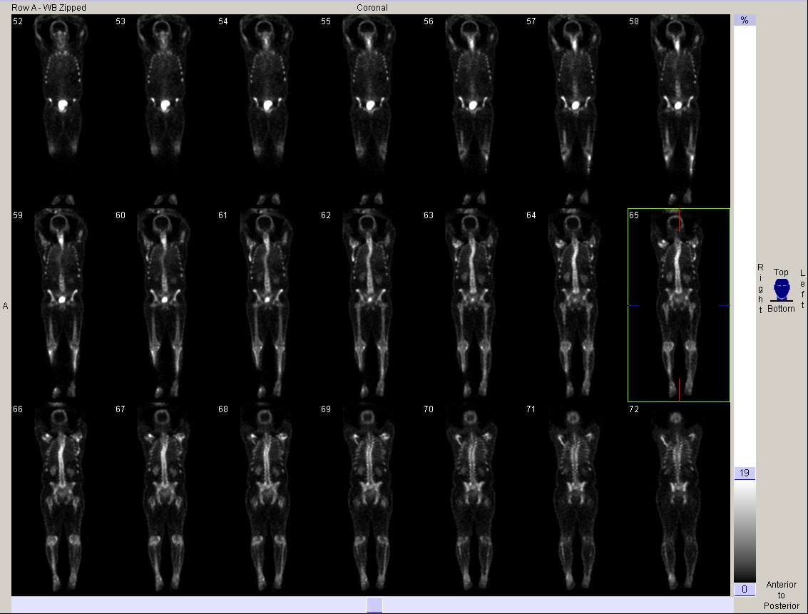 Nuclear Medicine Technology Program: Whole Body Bone SPECT