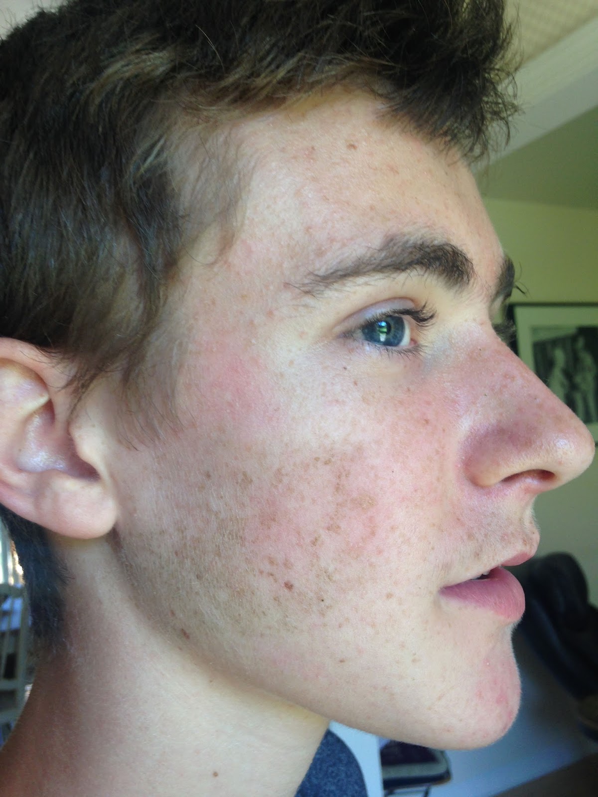 VIRTUAL GRAND ROUNDS IN DERMATOLOGY 2.0: Dermatitis Neglecta