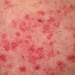 Bercak Merah dan Bernanah Pada Kulit