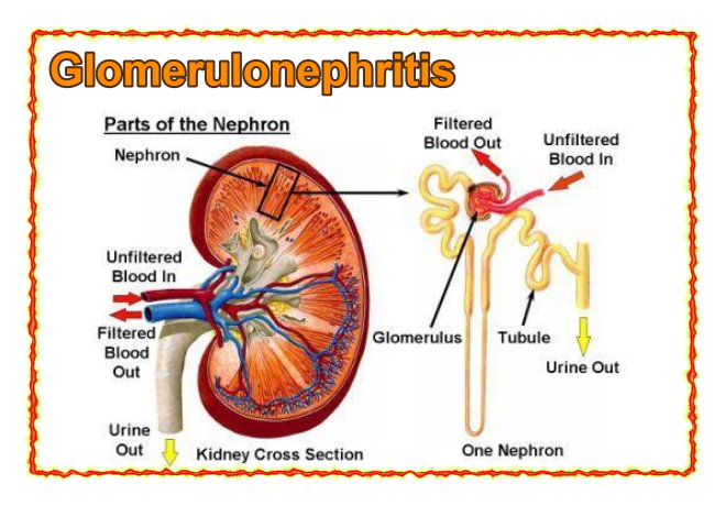 Acute glomerulonephritis - Sure Developers Team