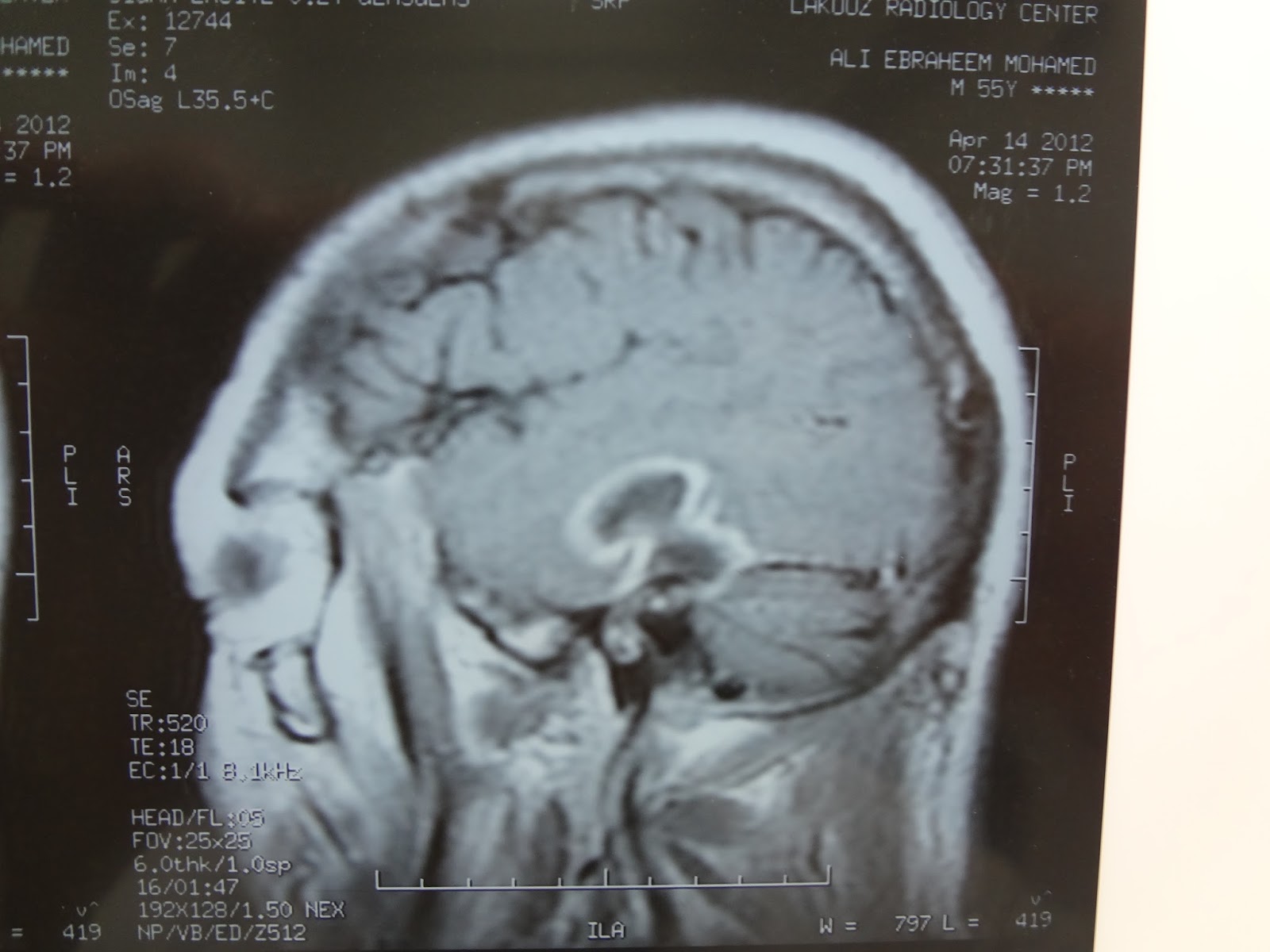 lt temporal lobe abscess complicating attico antral cholesteatoma MRI ...