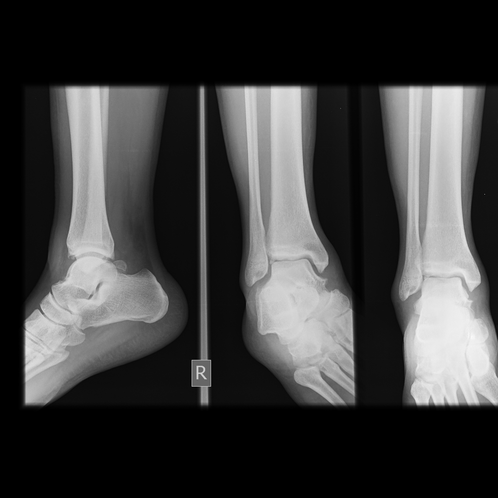 Joint Preservation and Replacement : anterior and posterior impingement ...