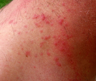 Brown Tail Moth Rash Pictures | Medical Pictures and Images - (2023 ...