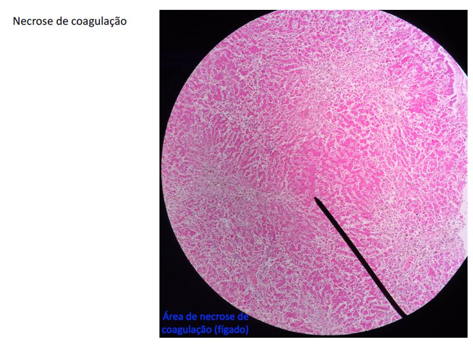 HISTOLOGIA90: TIPOS DE NECROSE