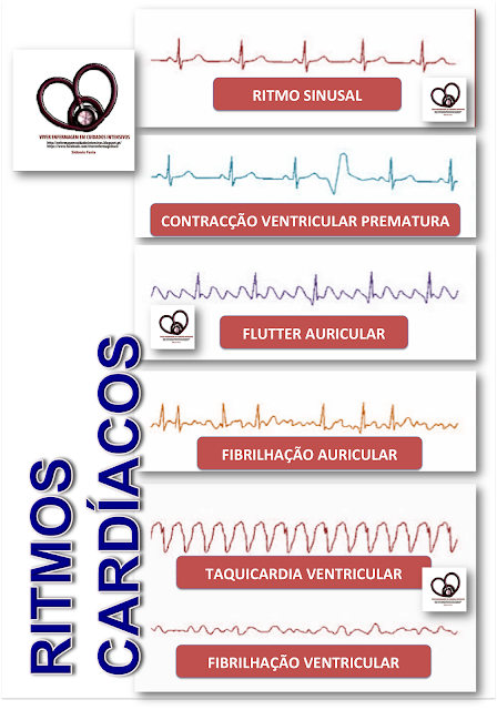 Viver Enfermagem em Cuidados Intensivos: RITMOS CARDÍACOS
