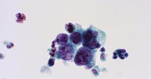 Brady Urology at Johns Hopkins Hospital: Urine Markers for Urothelial ...