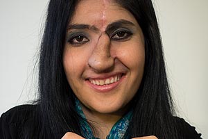 Bibi Aisha Before And After