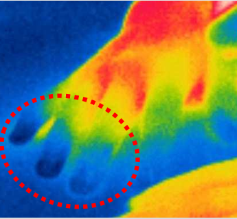 Eggetsberger-Info, Blogger, Blog: Raynaud-Phänomen, vor allem junge ...
