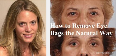 How Do I Get Rid of Eye Bags Naturally ? - Life Is Beautiful