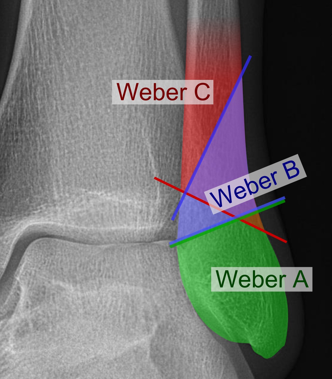 Weber Ankle Fracture - Classification | Treatment | Surgery
