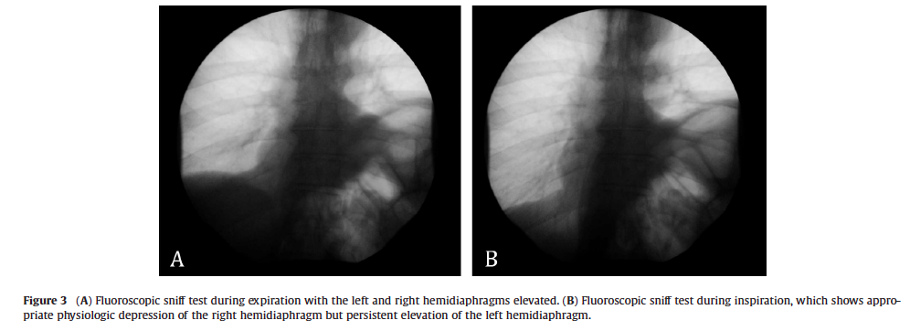 Shoulder Arthritis/Joint Replacement Rotator cuff tears: Interscalene ...