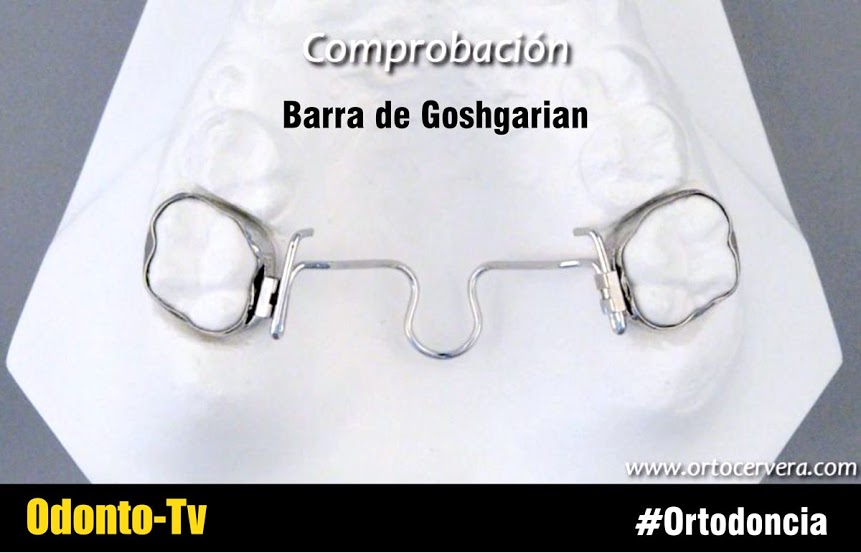 ORTODONCIA: Barra de Goshgarian Preformada - Adaptación