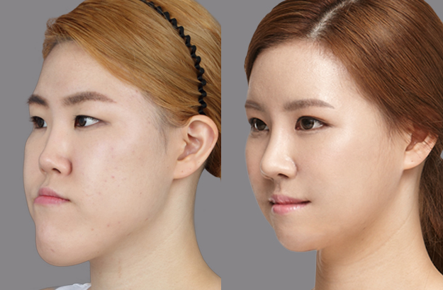 [Before and After Photos] Korean Two Jaw Surgery - 짱이뻐!