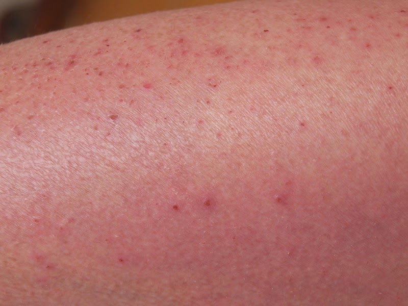 Atopisch eczeem behandelen met haakwormen: Slecht, slechter, slechtst