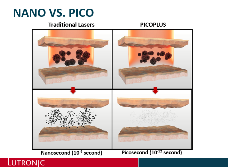 There is different type of laser??? 【Picoplus Laser VS Traditional ...