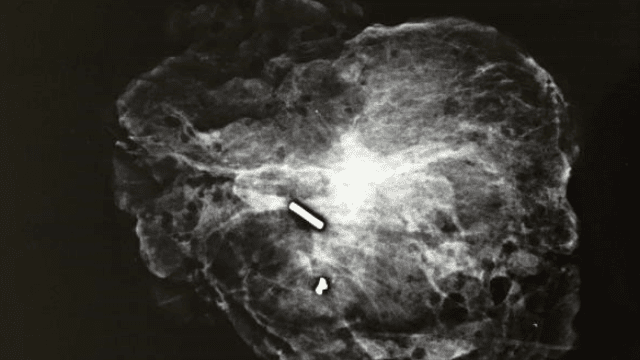 Ob/Gyn Updated : Magseed, a minimally invasive breast marker for cancer ...